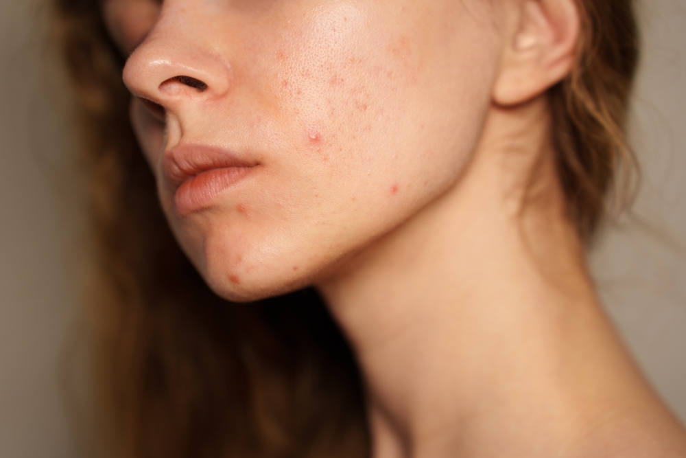 PCOS and Acne: Symptoms and Treatment - Femexcel Blog